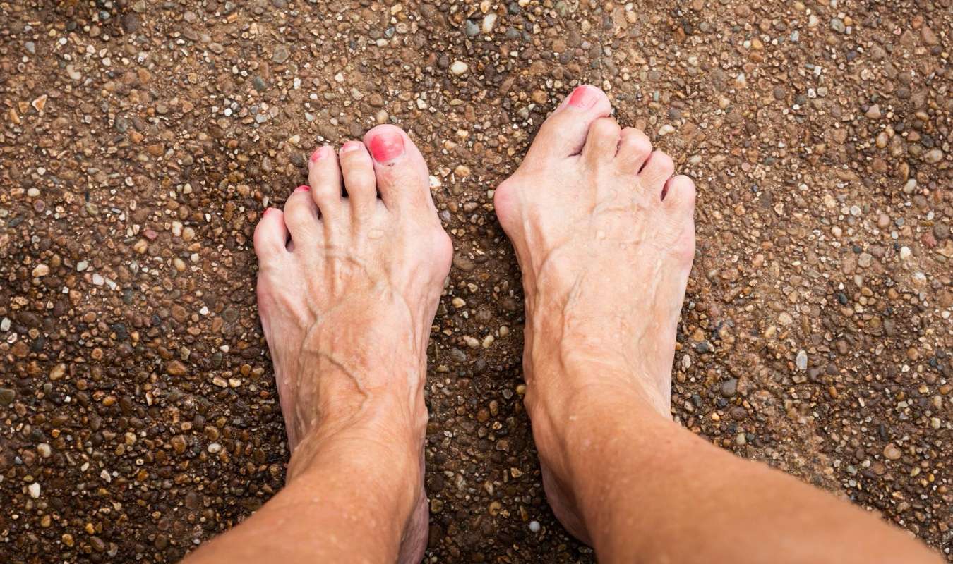 difference between callus bunion and corn